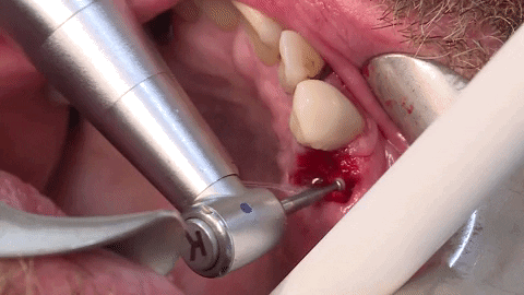 OsteoGen® Plug: Clinical Guide